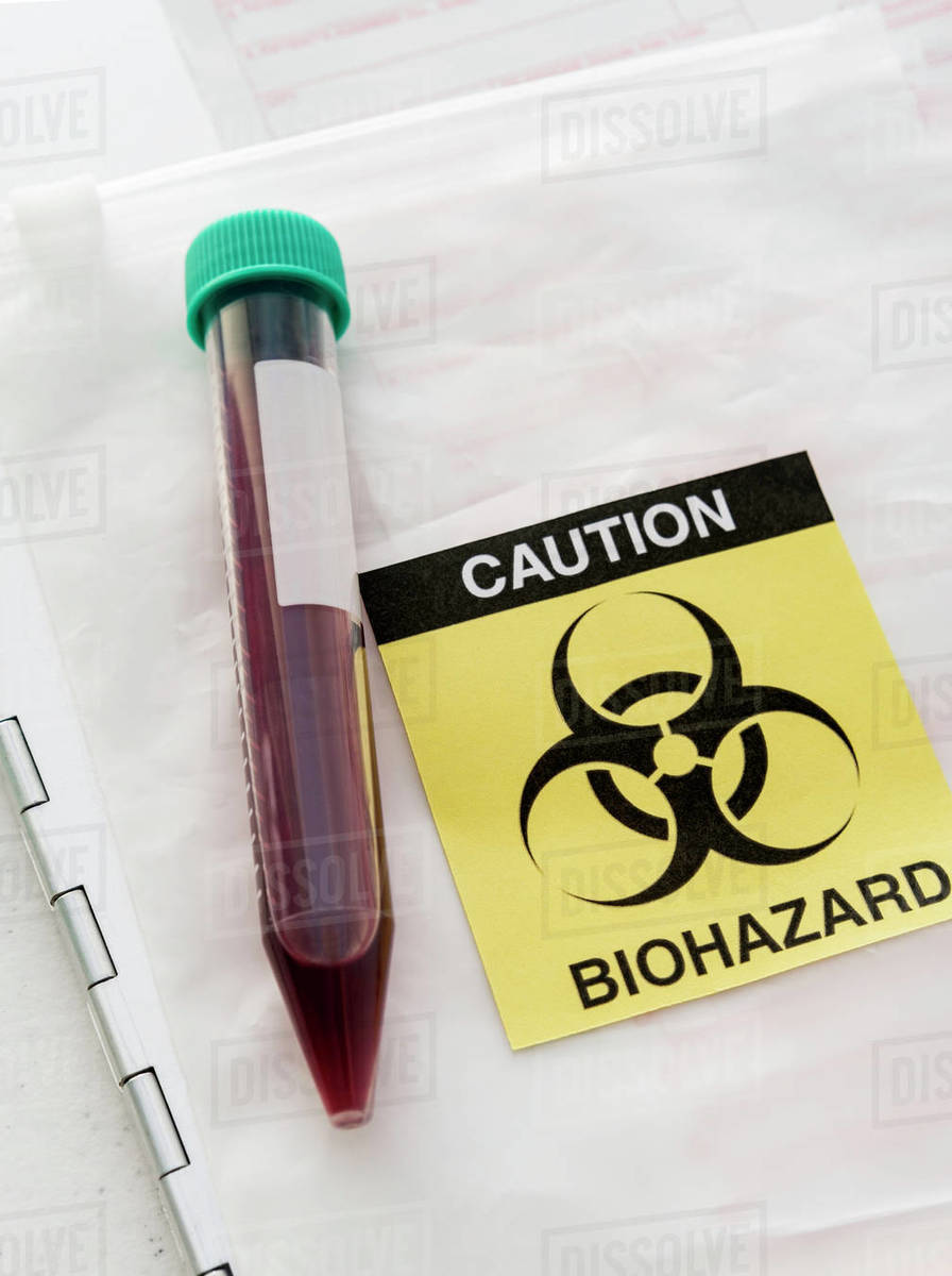 Blood sample with biohazard sign - Stock Photo - Dissolve