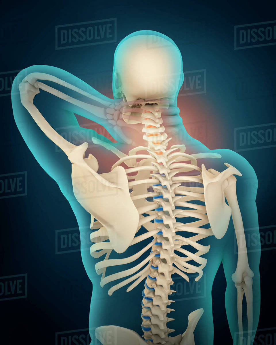 Medical illustration showing inflammation and pain in human neck area ...
