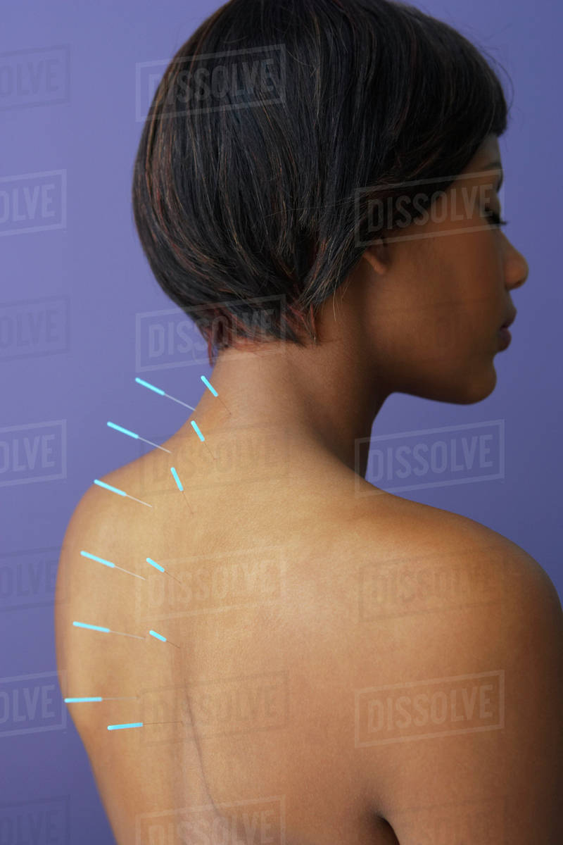 Acupuncture needles in African woman's back - Royalty-free Stock Photo ...