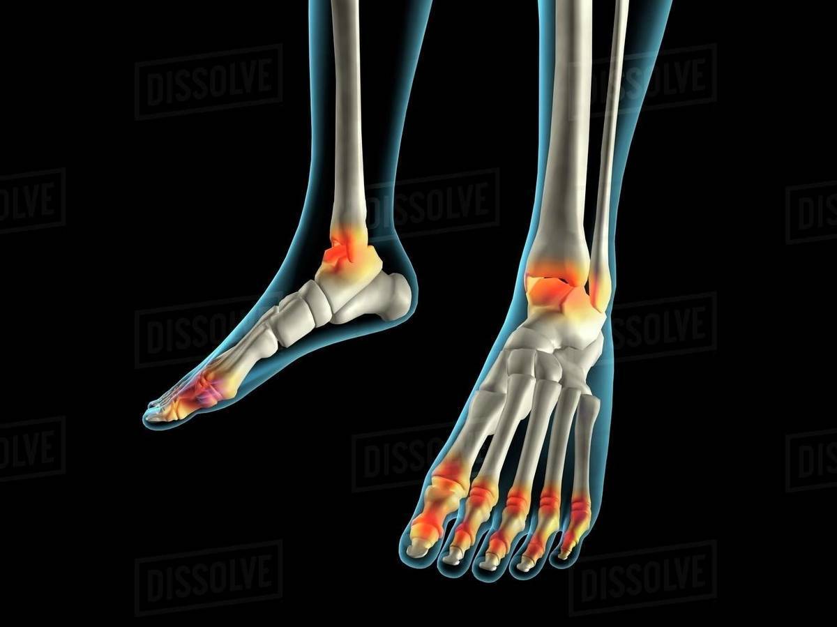 X-ray view of inflamed foot bones - Stock Photo - Dissolve