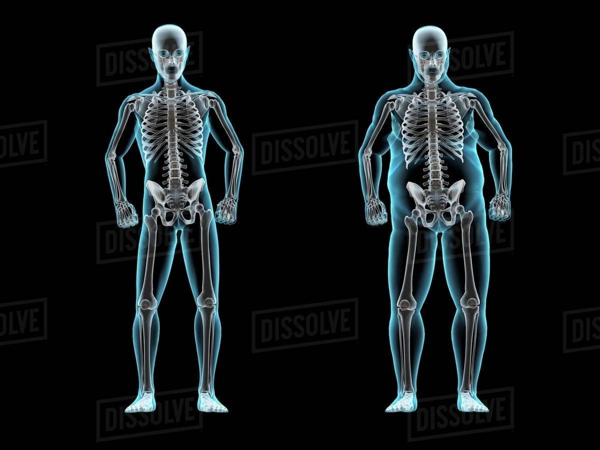 Thin and obese men, X-ray image - Stock Photo - Dissolve