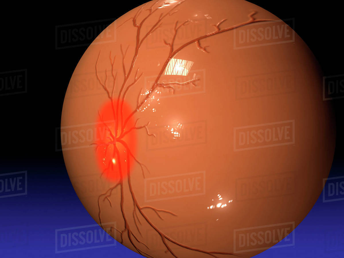 Close-up of the human eyeball with retinal damage caused by glaucoma ...