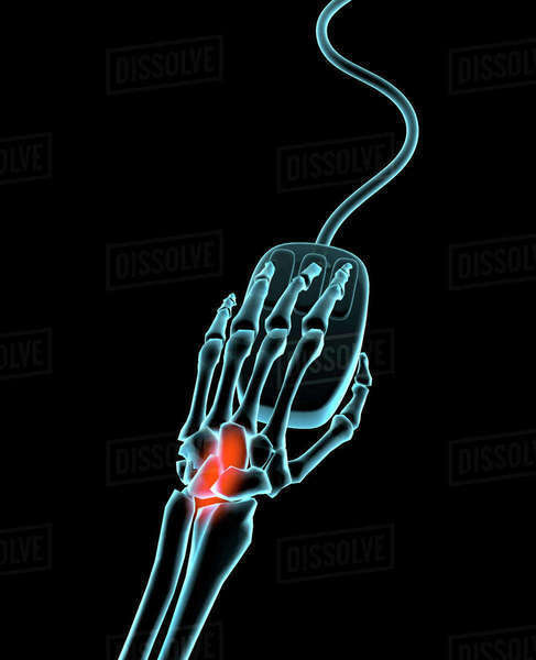 Skeleton of the human hand using a computer mouse showing carpal tunnel ...