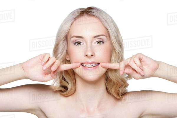 Portrait of a young Caucasian woman pointing to her teeth with braces ...