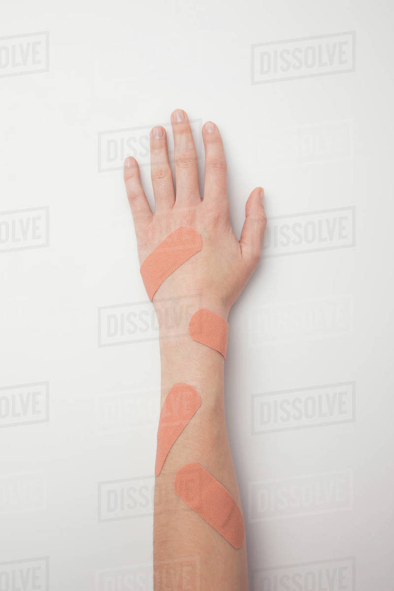 Cropped image of hand with many beige patches - Royalty-free Stock ...