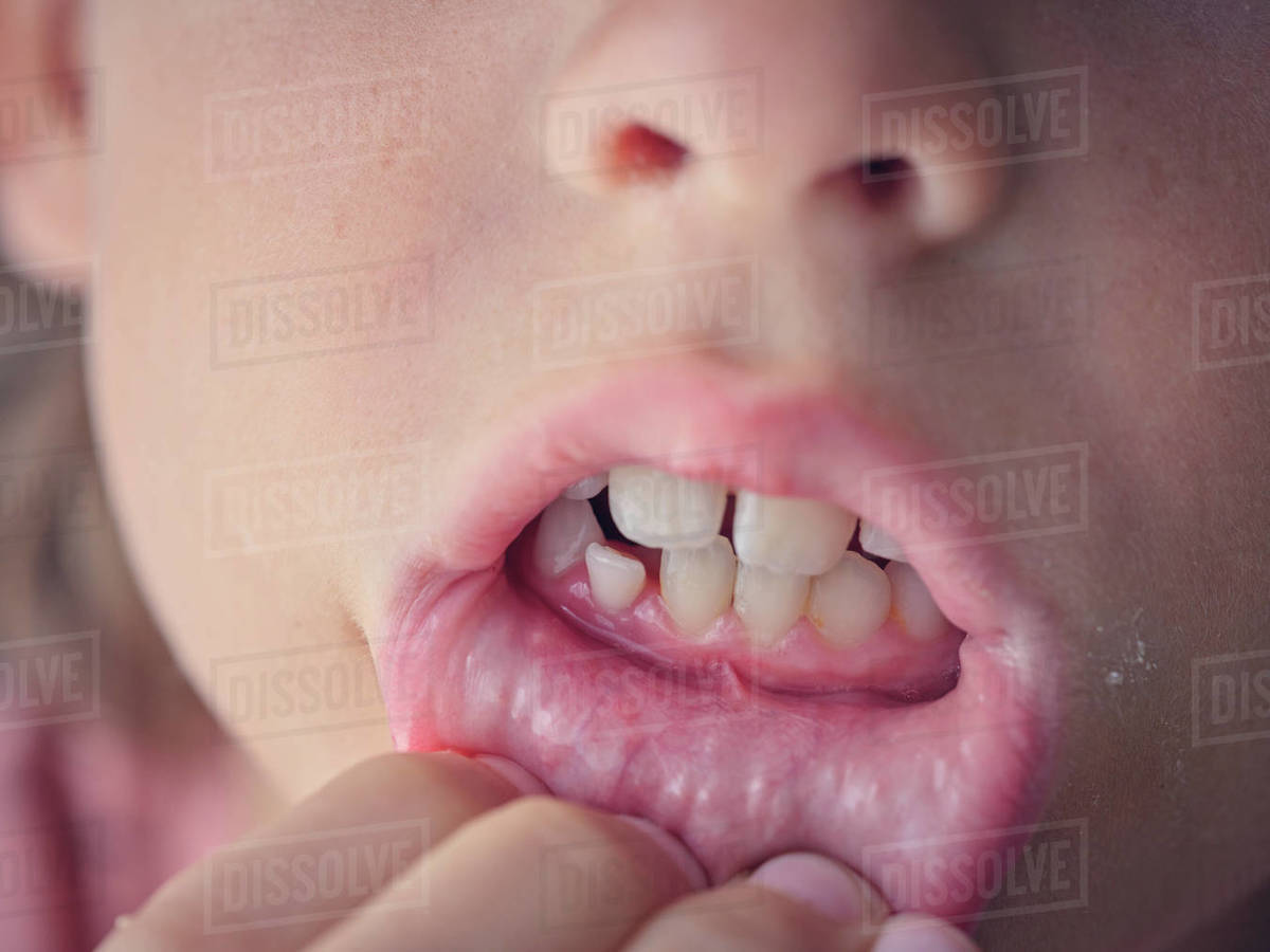 Unsteady baby tooth in wide open mouth of anonymous child pulling lip ...