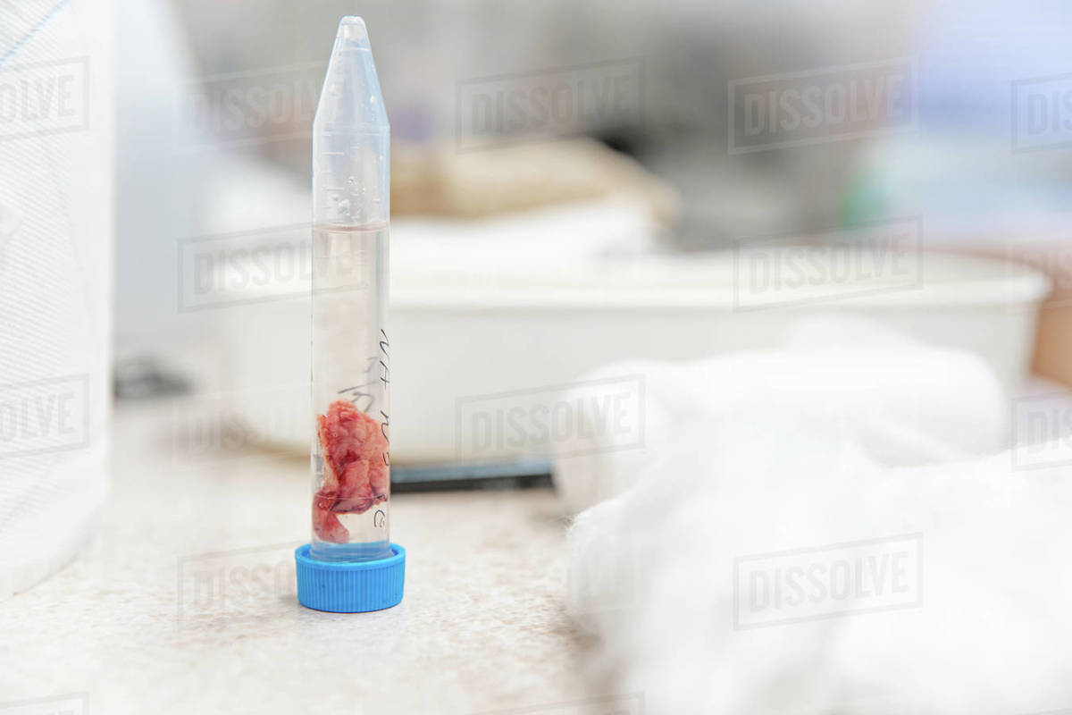 a tissue sample from the tumor to be sent for histological expertise ...