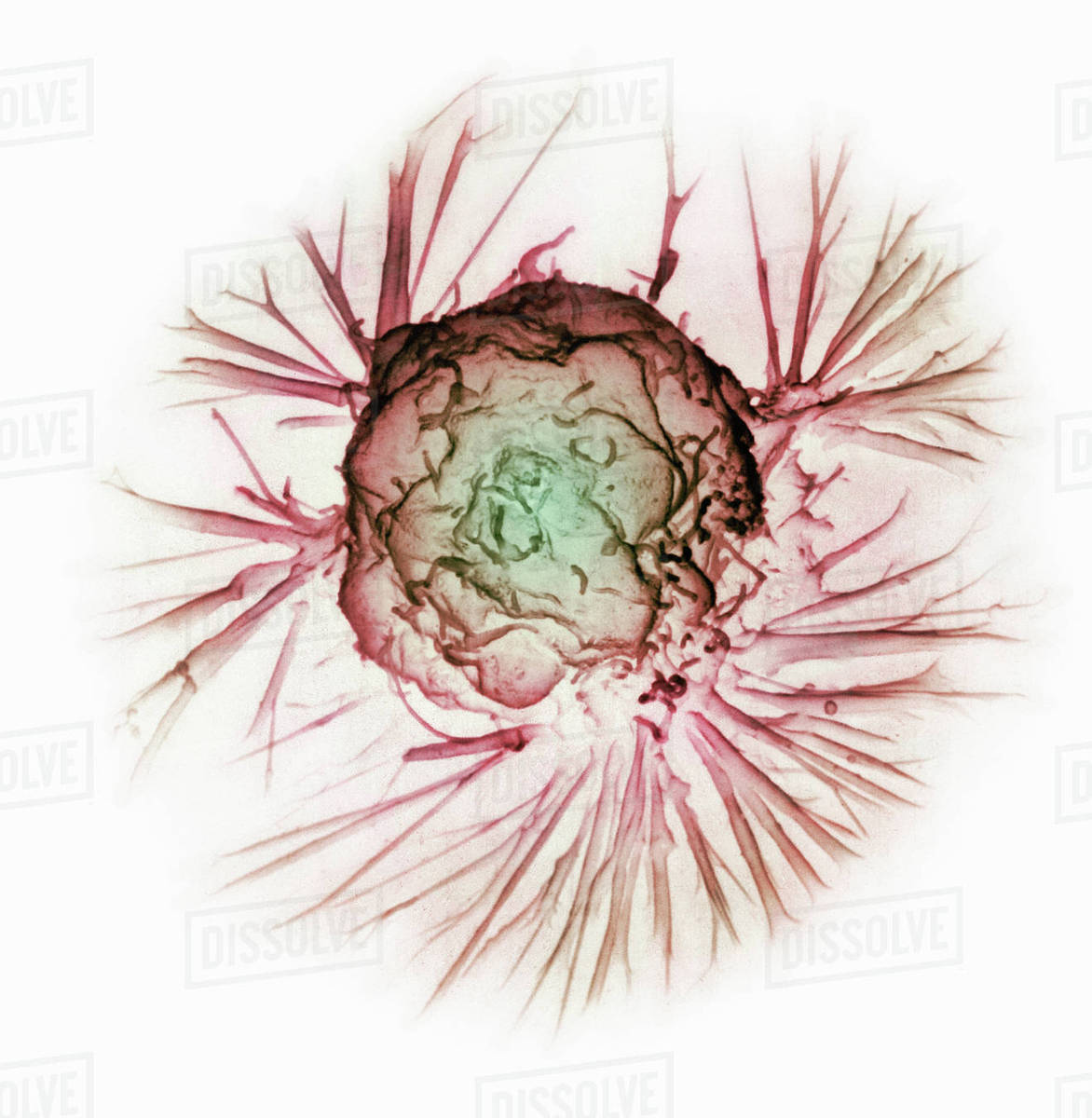 Scanning Electron micrograph, breast cancer cell - Royalty-free Stock ...