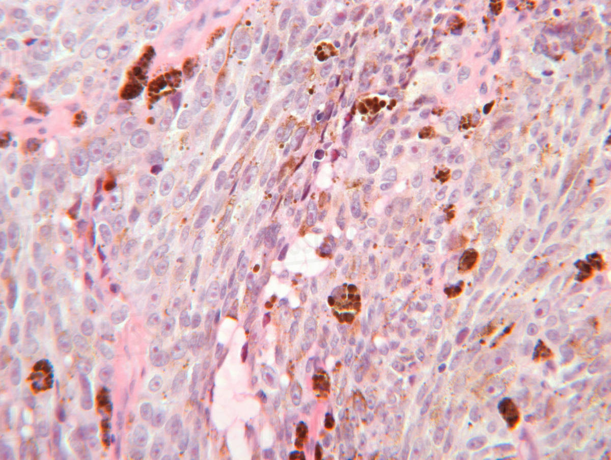 Microscope view of malignant melanoma - Royalty-free Stock Photo | Dissolve