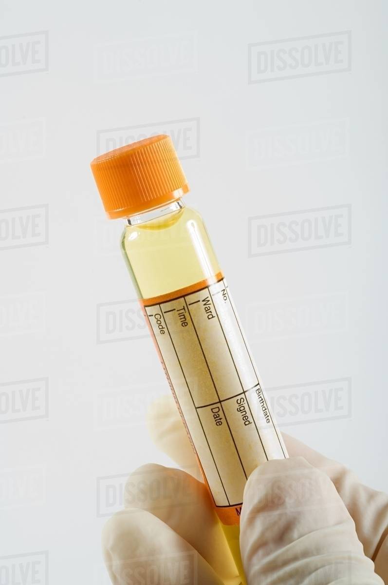 Person holding urine sample - Royalty-free Stock Photo | Dissolve