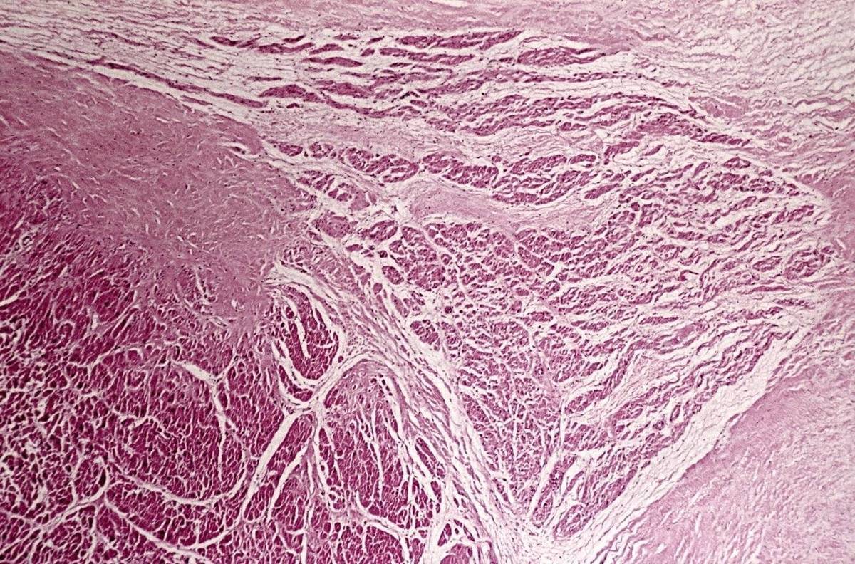 Atrioventricular node - Stock Photo - Dissolve