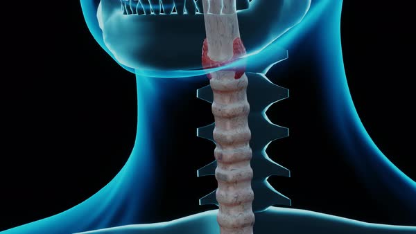 Nodular goiter in human body. 3D render animation of tissue problem ...