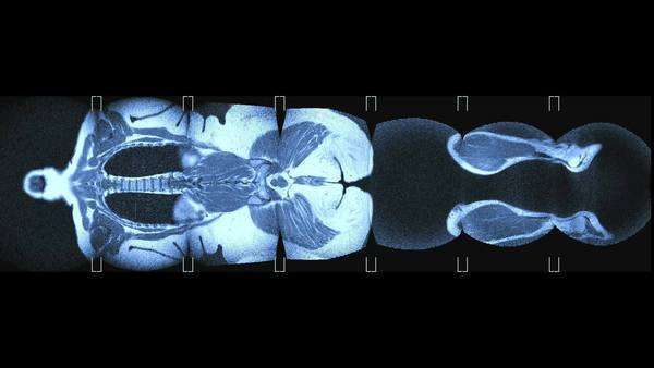 Coloured sequence of magnetic resonance imaging (MRI) scans through the ...