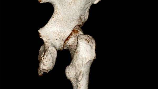 Rotating 3D MRI scan of a hip joint, showing moderate osteoarthritis ...
