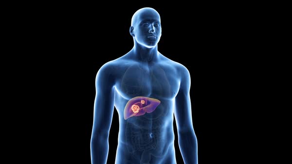 Human body rotating against a black background, showing liver cancer ...