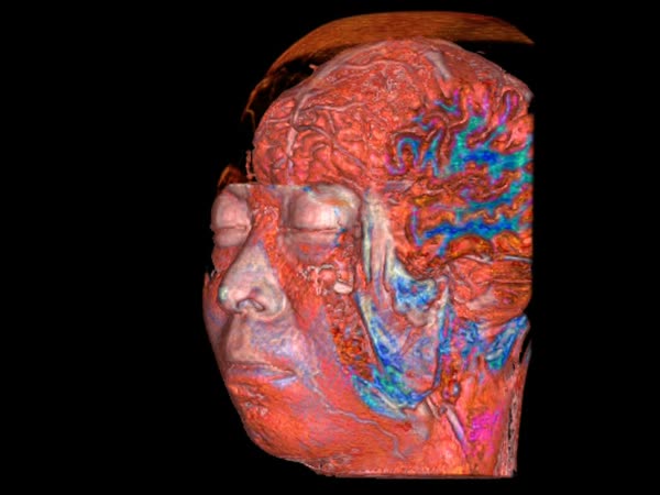 Brain and spinal cord, rotating sagittal 3D MRI scan - Stock Video ...