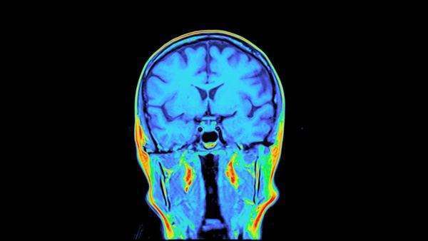 Coloured coronal MRI scans of a normal healthy brain. - Stock Video ...