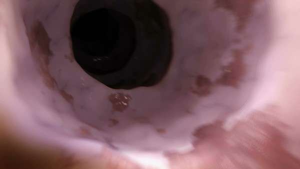 Human colon disease, animation. The patches are indicative of a ...