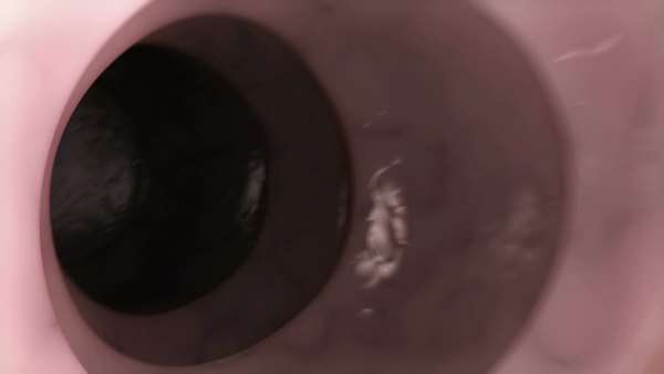 Animation of the inside of the large intestine showing faecal impaction ...