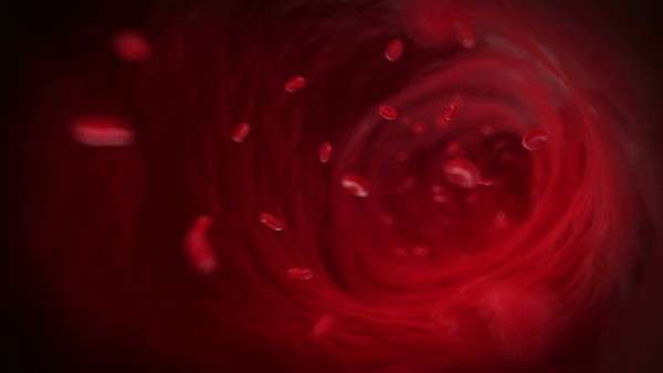 Atherosclerosis, animation. Atherosclerosis is the narrowing of ...