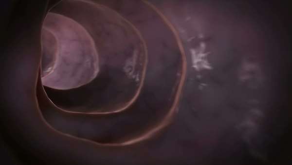 Animation of the inside of the large intestine showing faecal impaction ...