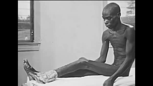 Patients suffering with Tuberculosis, keloid, Ainhum, Tropical Ulcers ...