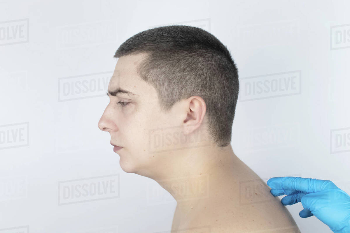 Kyphosis. The man suffers from a curvature of the spine in the upper ...
