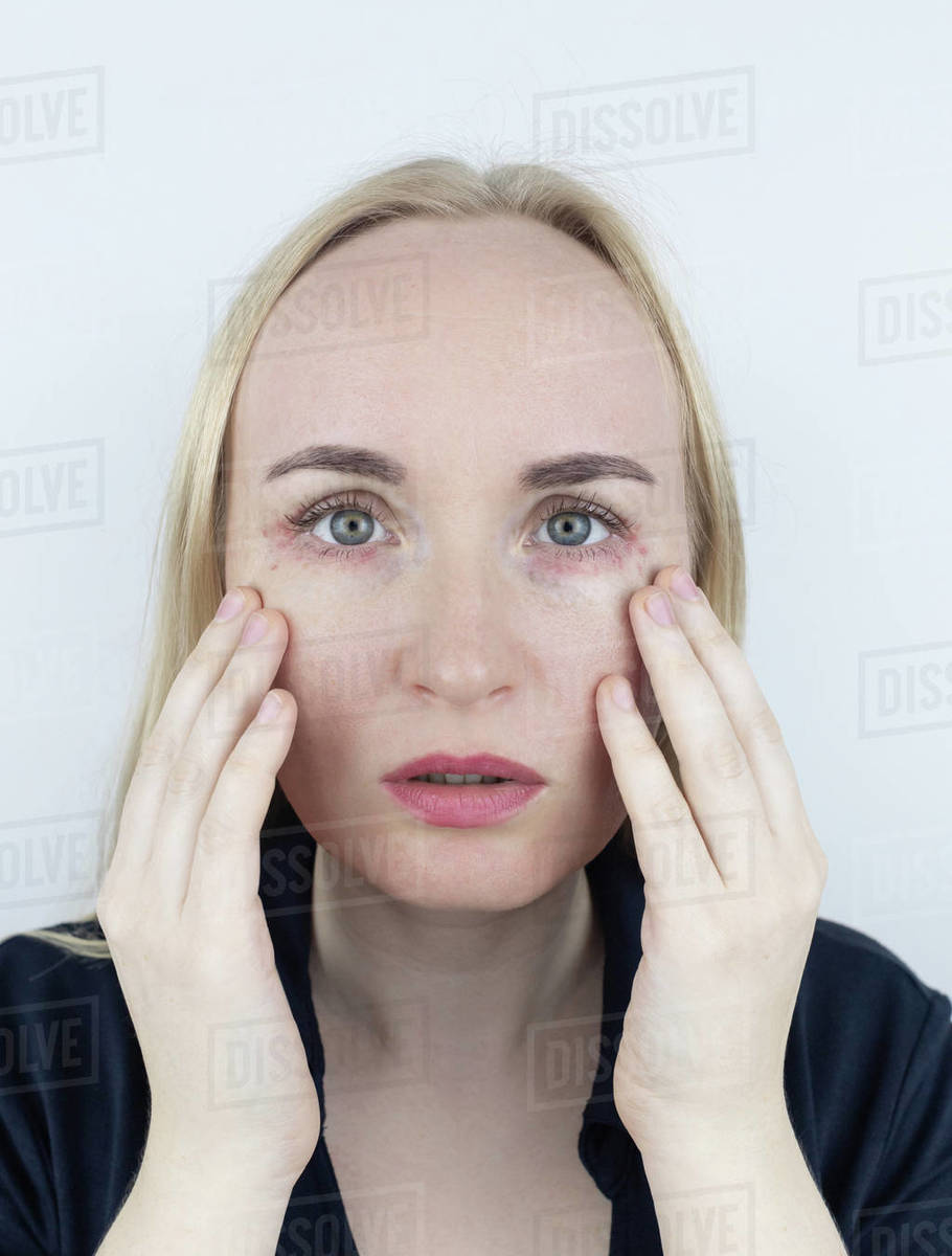 Allergy to cosmetics. The girl looks at the pimples around her eyes ...