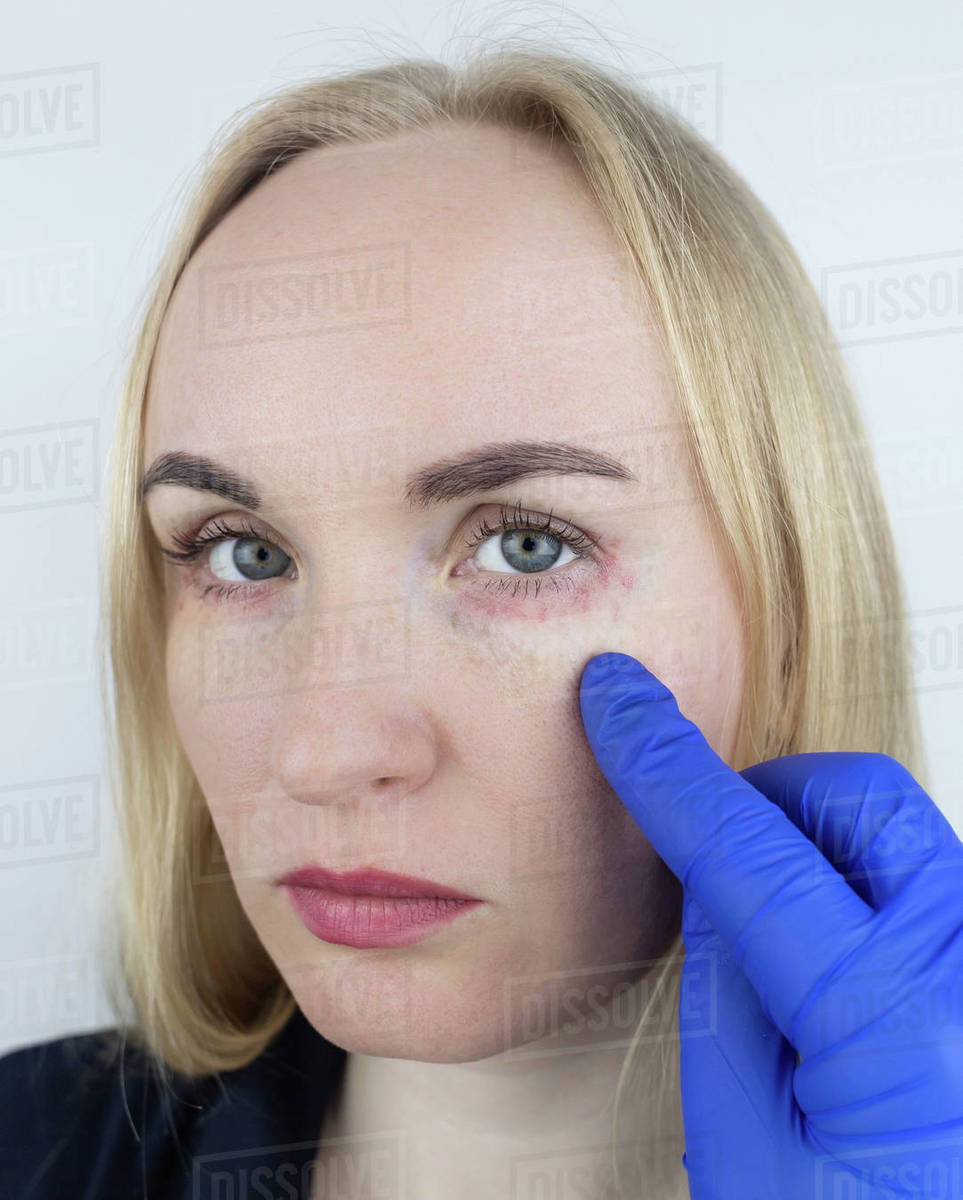 Allergy to cosmetics. The girl looks at the pimples around her eyes ...