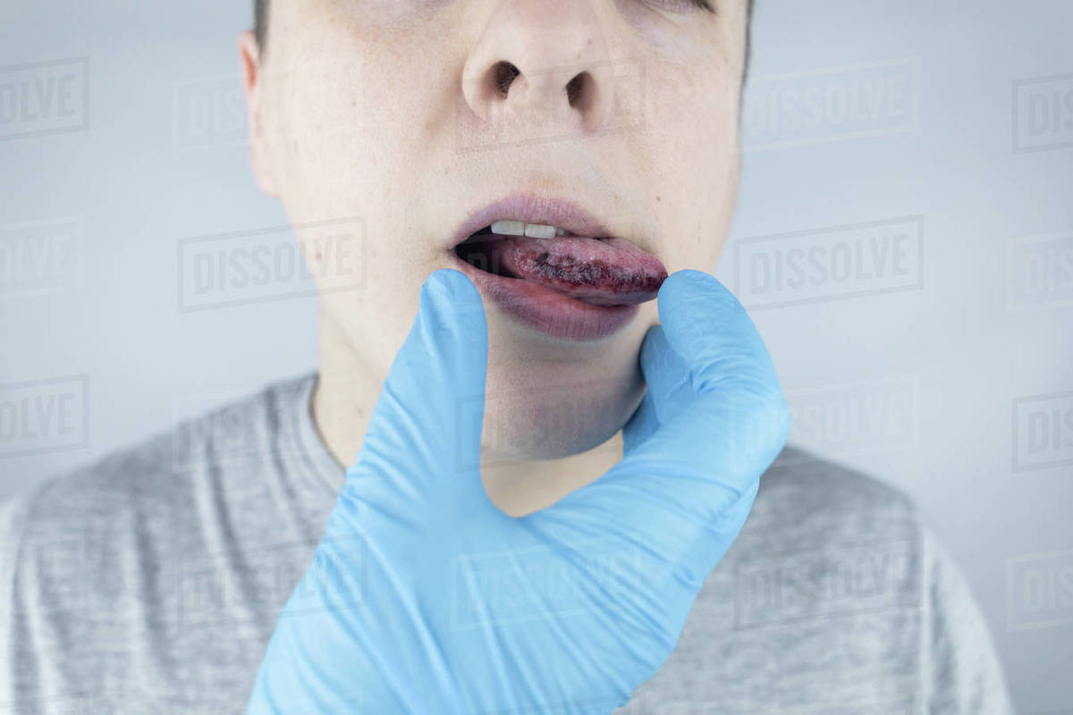 Black tongue. A man shows the consequences of an injury, bite or burn ...