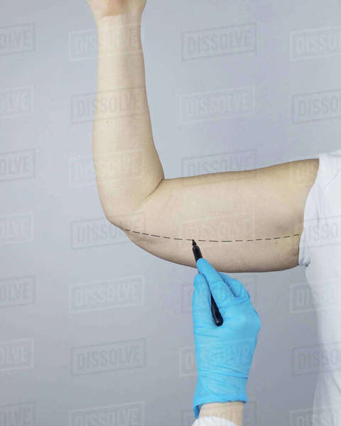 Brachioplasty. Plastic arms, dangling skin at the elbow. An older woman ...