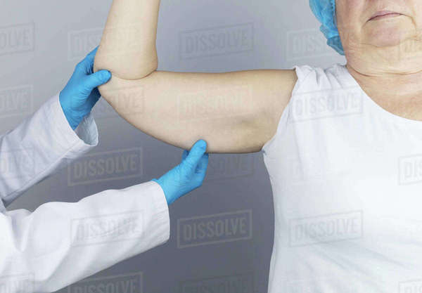 Brachioplasty. Plastic arms, dangling skin at the elbow. An older woman ...