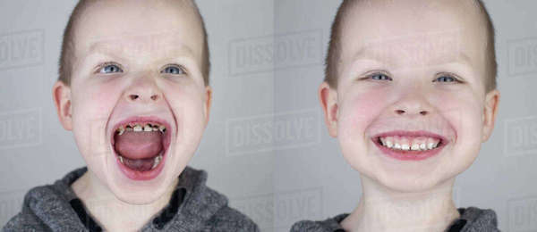 Before and after. The child shows the damaged teeth by caries, and in ...