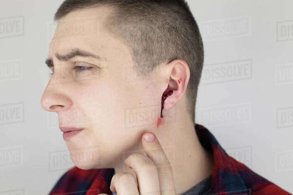 A man whose ear is bleeding. Vascular rupture, damage to the tympanic ...