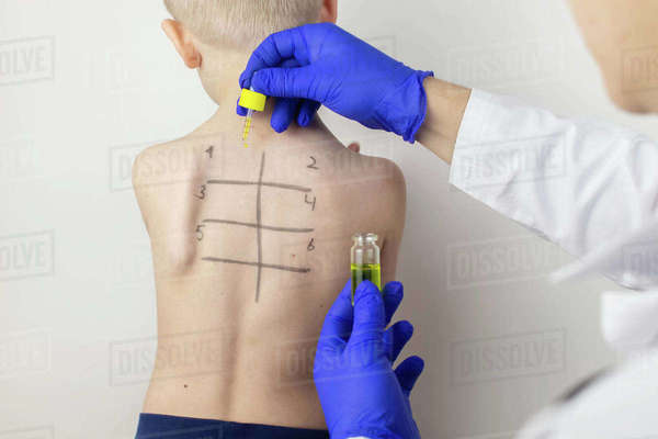 An allergist in the laboratory conducts an allergy prick-test. Skin ...