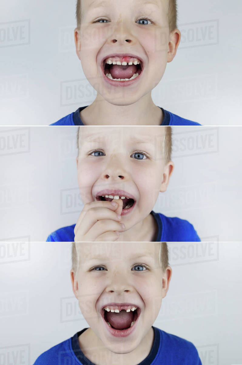 Before and after. Falling out milk tooth. Blond boy in photo has a ...