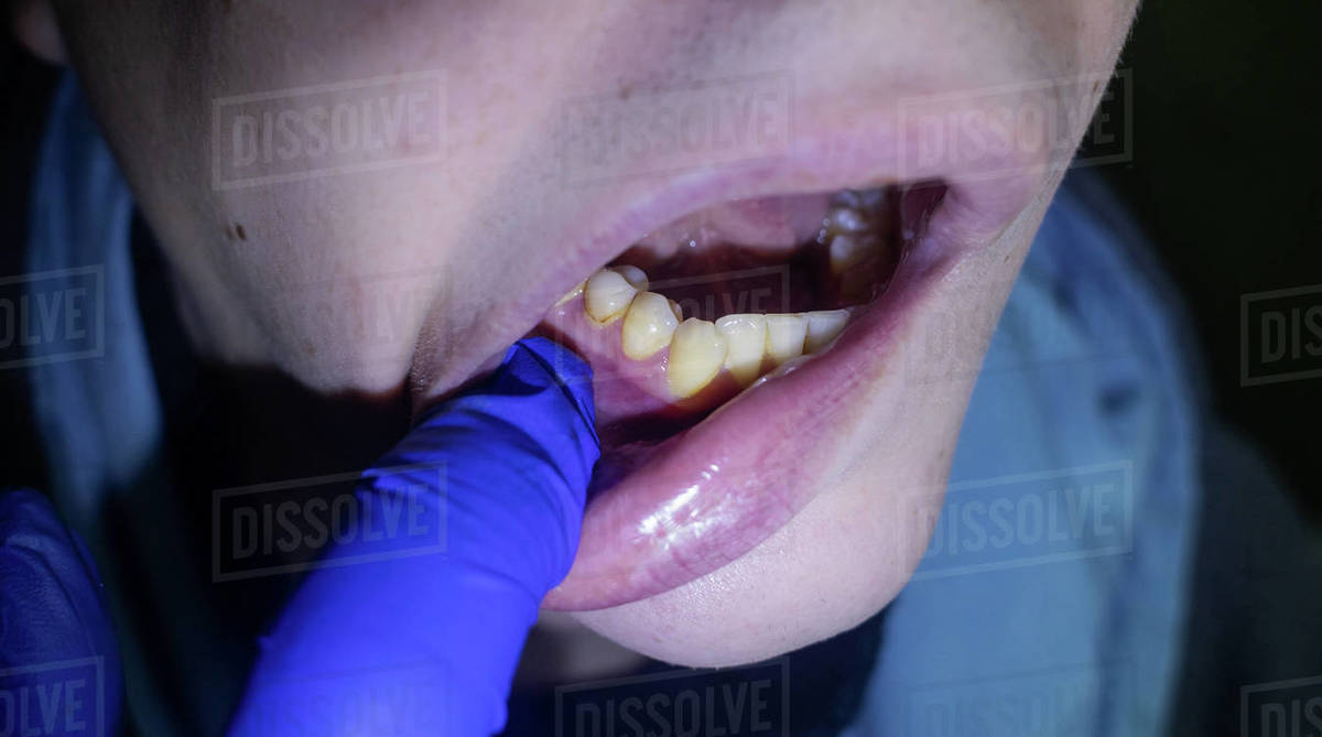 Tartar removal. Before and after the procedure for cleaning the tooth ...