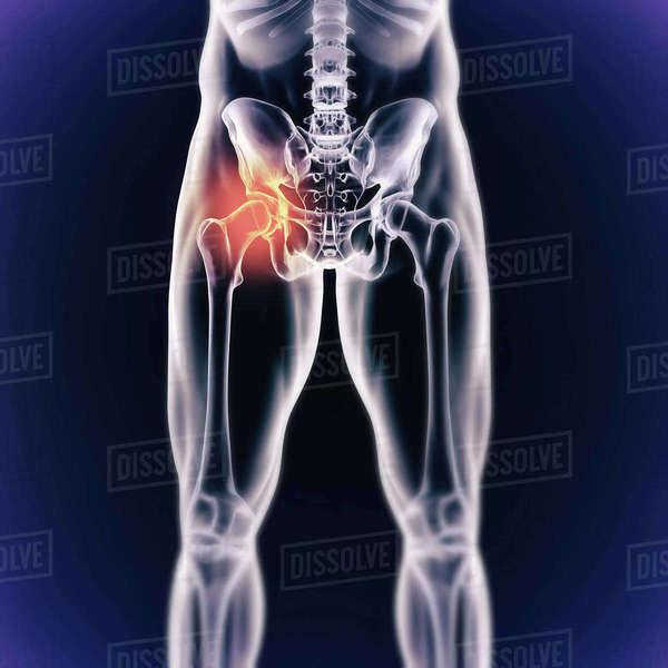 Hip pain, anatomy x ray scan of person with internal injury and cgi ...
