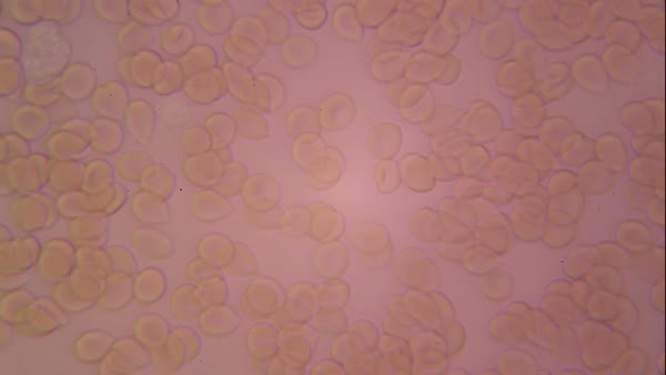Microscopy: Human Blood. Blood Clots Under Microscope. Red Blood Cells ...