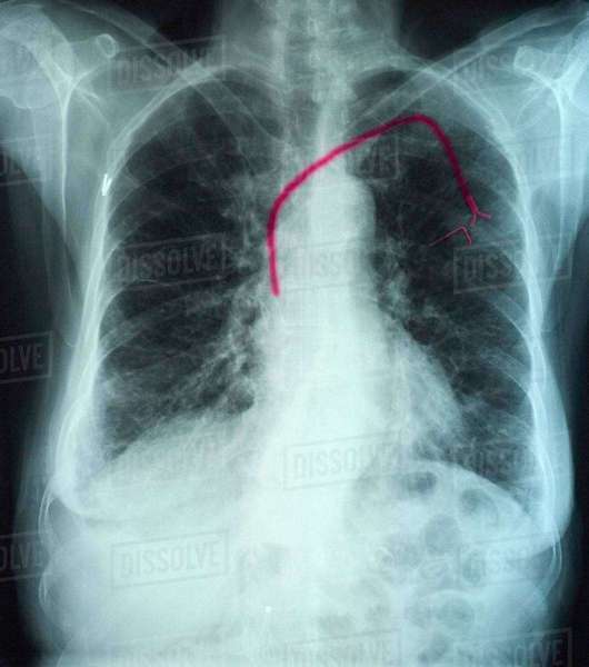 Chest xray showing infusion port into the heart - Stock Photo - Dissolve