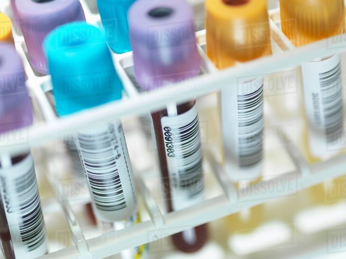 A row of human blood and chemistry samples awaiting testing in the lab ...