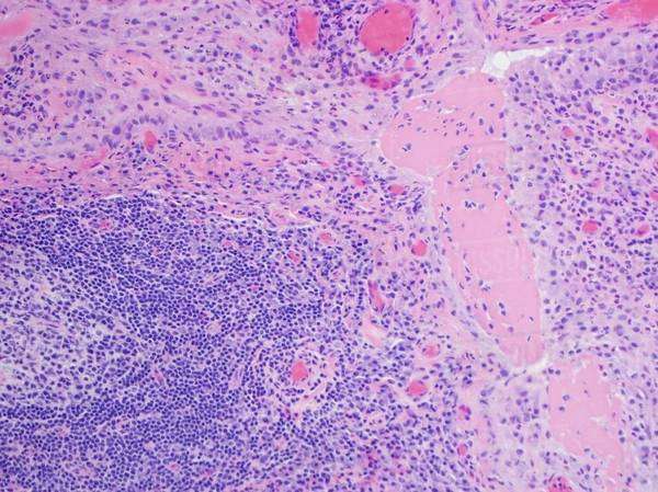 H&E stain, light microscopy, rheumatoid arthritis of joint showing ...