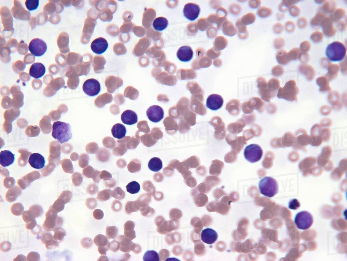 Neoplastic lymphocyte cells in blood - Royalty-free Stock Photo | Dissolve