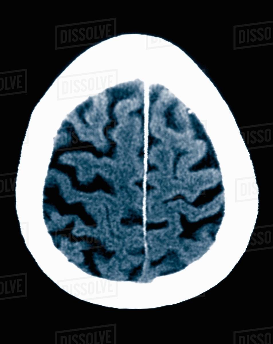 CT scan 84 year old male with Alzheimer's disease. CT shows brain ...