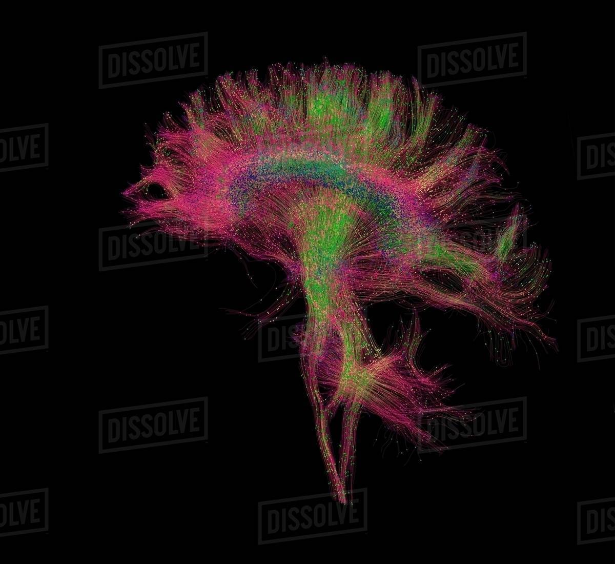 Diffusion MRI, also referred to as diffusion tensor imaging or DTI, of ...