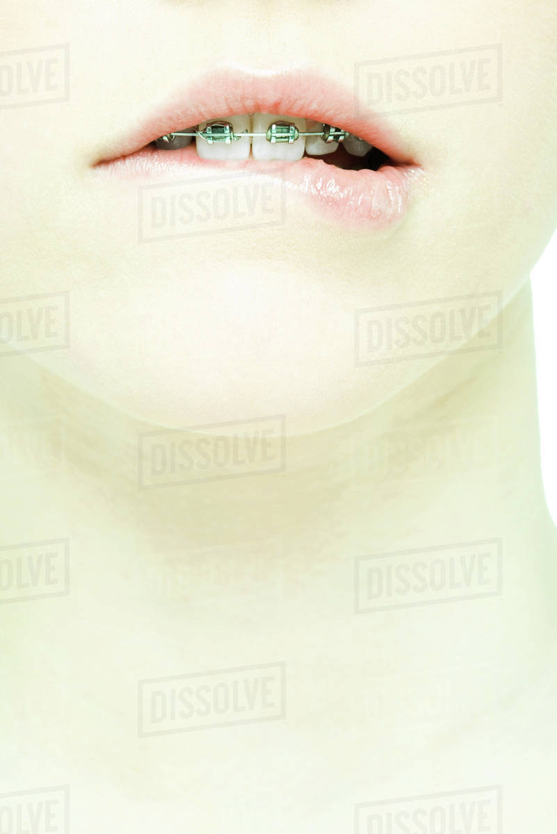 Teenage girl with braces biting lip, extreme close-up - Stock Photo ...