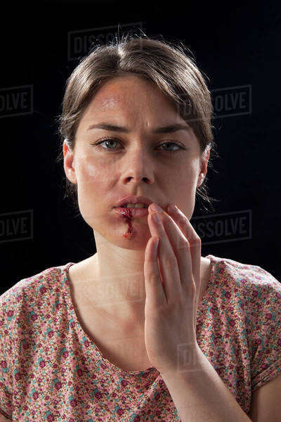 A woman with bruises and bloody lip - Royalty-free Stock Photo | Dissolve
